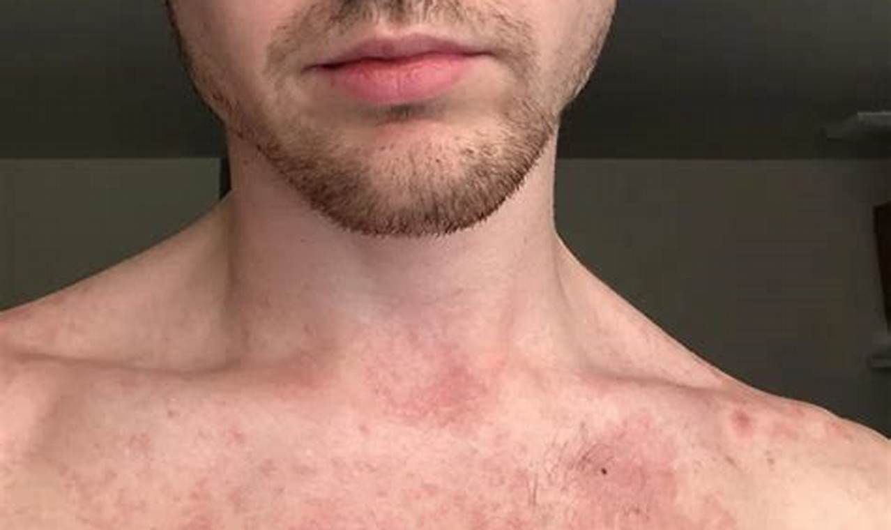 What is Vape Rash? Causes & Relief + Prevention Tips